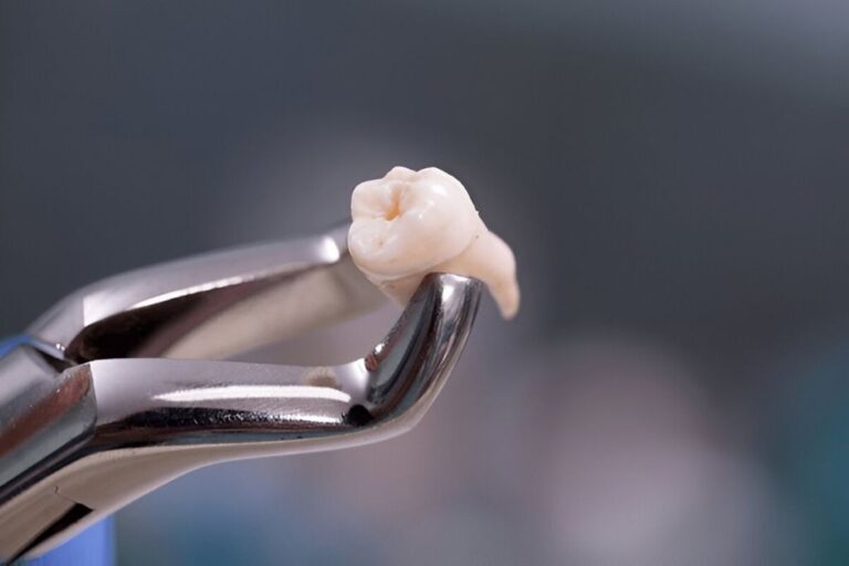 Wisdom Teeth Extractions Near Me in London, ON